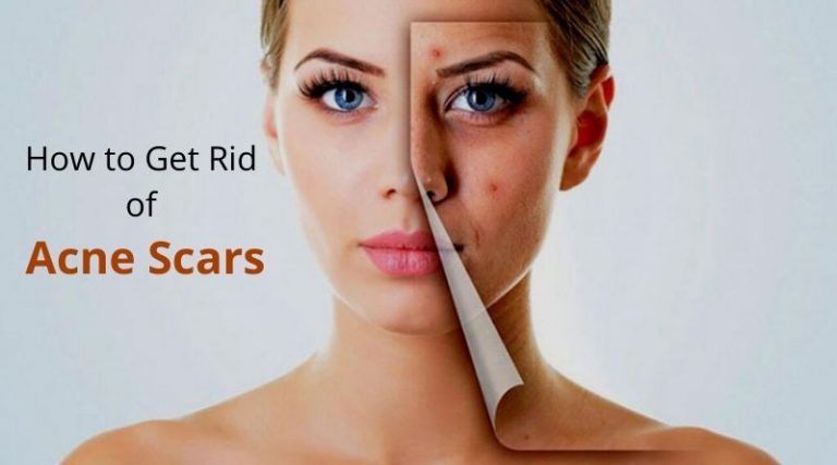 How to Get Rid of Acne Scars Fast at Home Naturally